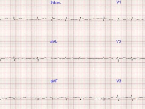 Atrial Fibrillation & Arrhythmias - NSW Cardiology